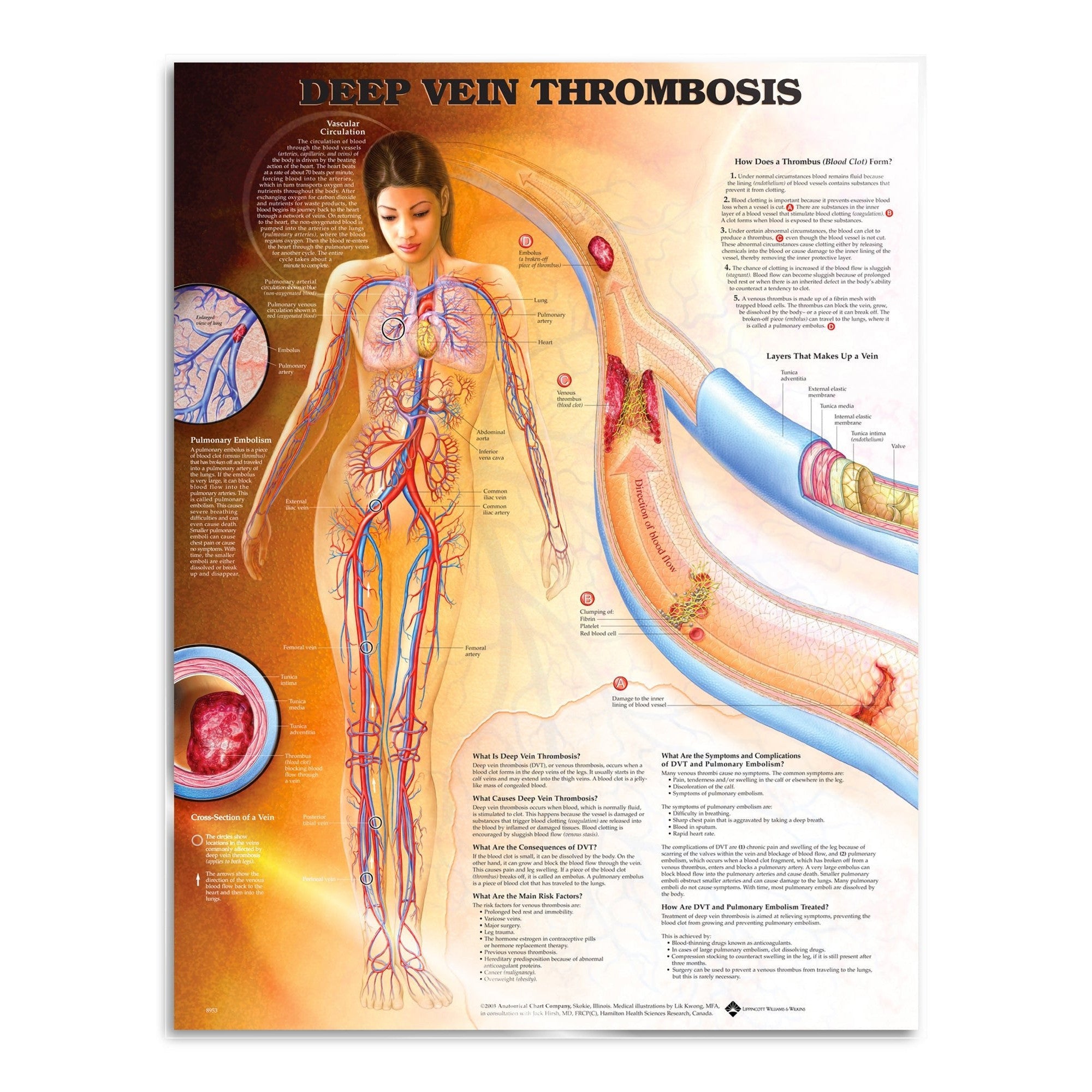 Deep Vein Thrombosis – Laminated Poster, English – eAnatomi