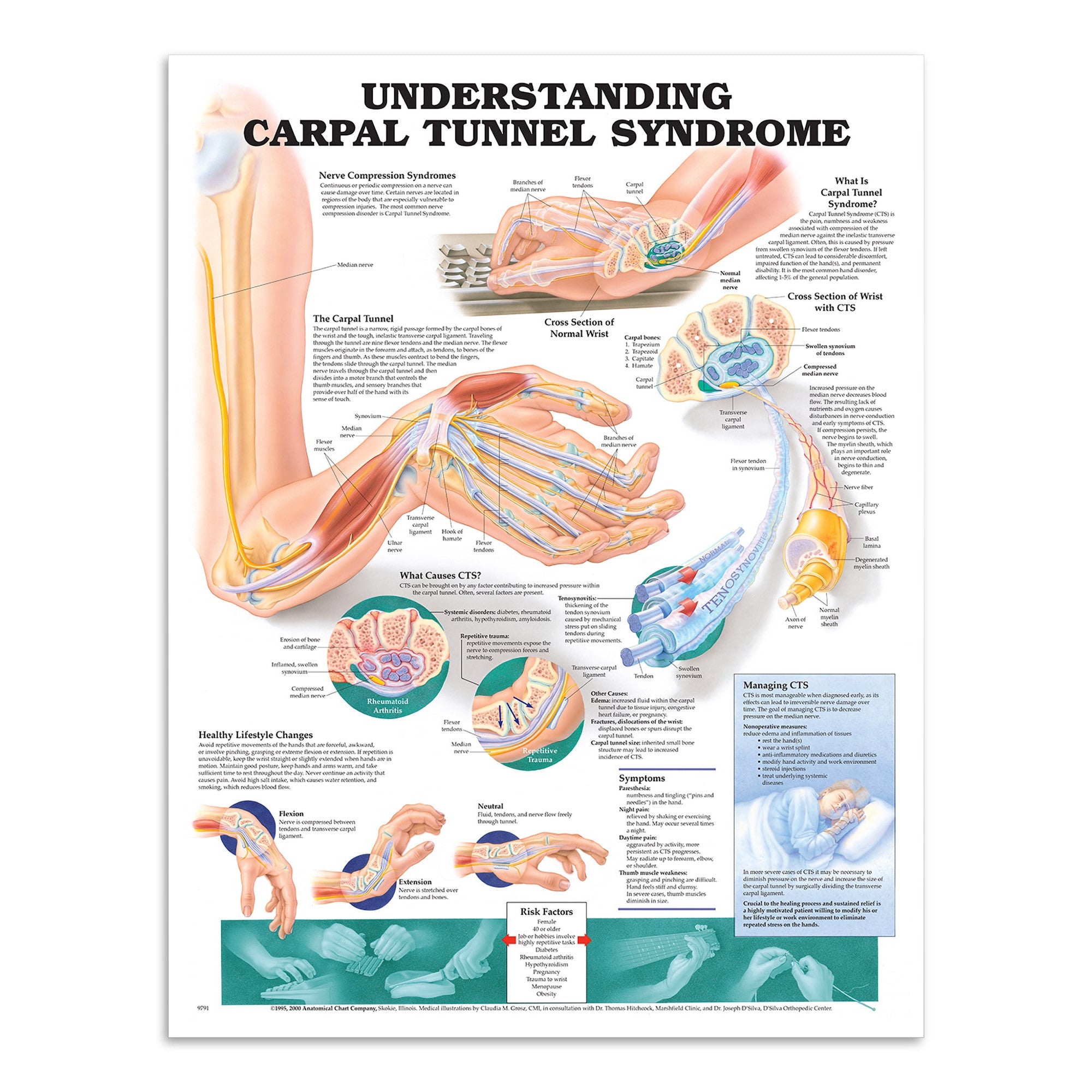Carpal Tunnel Syndrome – Anatomy Poster, English – eAnatomi